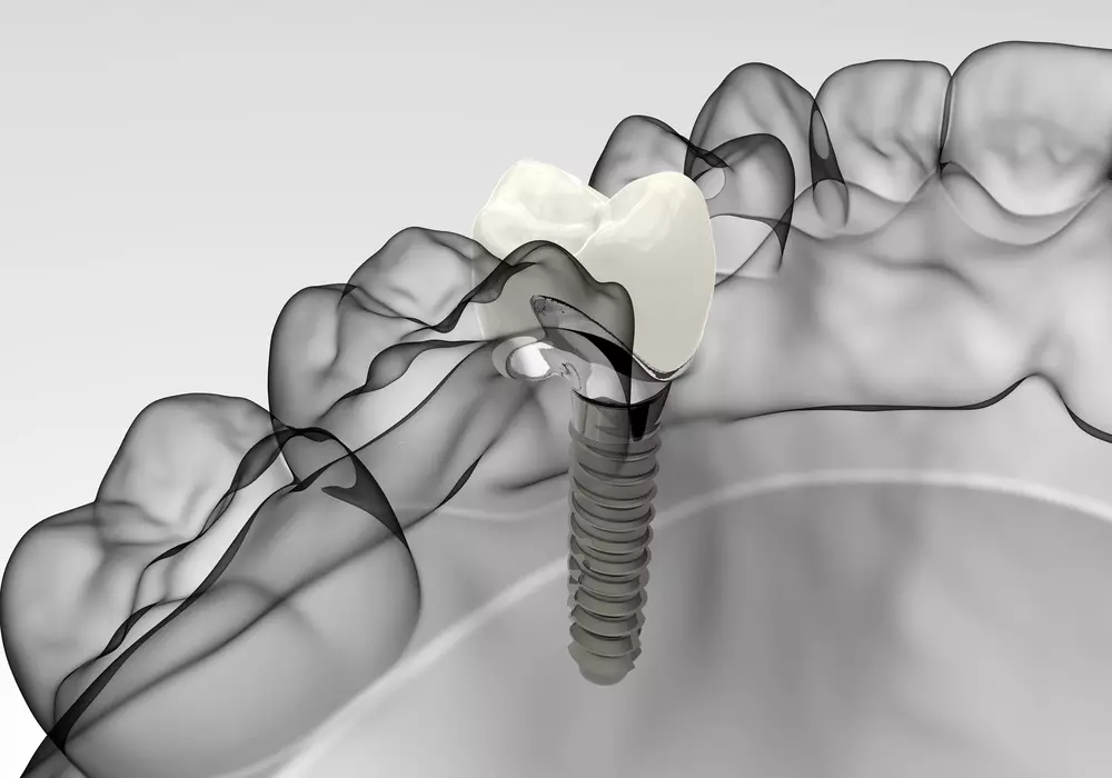 Nové zubné implantáty generujú energiu a sú odolné voči baktériám
