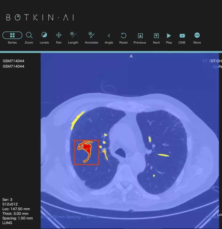 Znajduje raka i wyjaśnia: jak platforma Botkin.AI analizuje obrazy cyfrowe i szuka na nich onkologii 45196_5