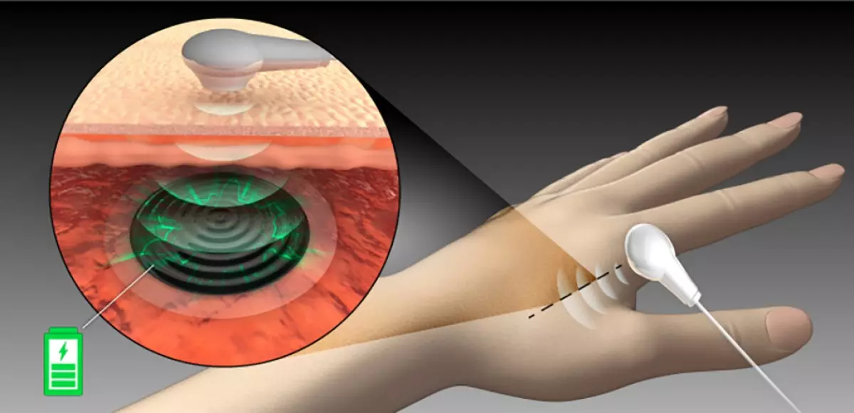Biobateri baru untuk implan perubatan boleh dikenakan ultrasound 47600_1