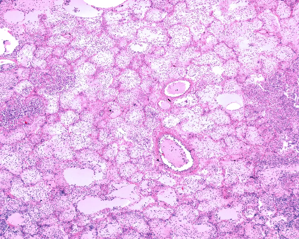 喘息、アテローム性動脈硬化症、糖尿病：COVID-19で最も危険な慢性疾患 55448_2