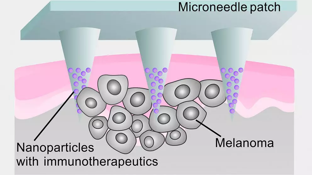 Microneedle पैच सफलतापूर्वक मेलेनोमा से लड़ता है 58126_1