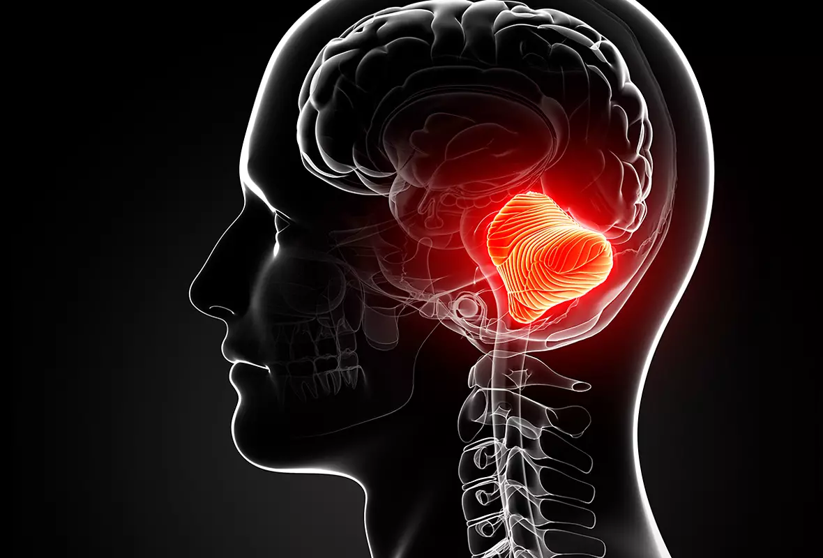 A sertés agyátültetése segít a Parkinson -kórban 58750_2