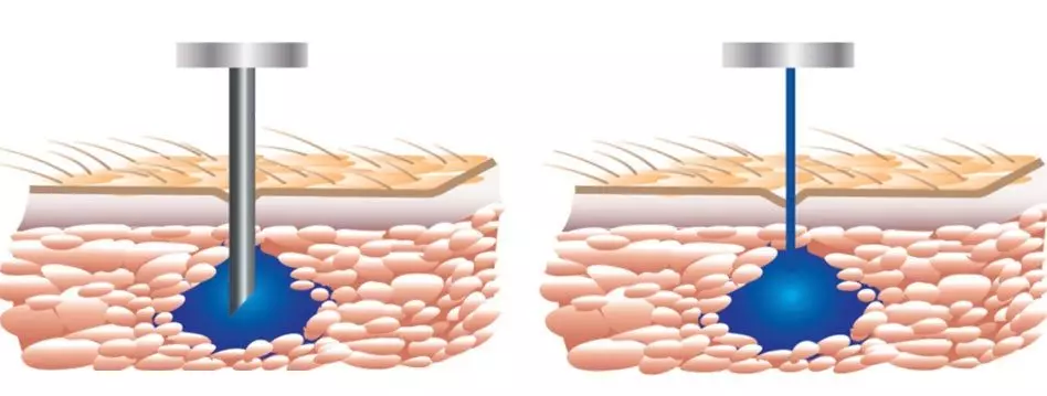 MIT has developed a device that will save patients from injections 64459_2