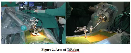 Den chéad uair, chabhraigh máinlia robot Síneach le máinliacht spine 65309_1