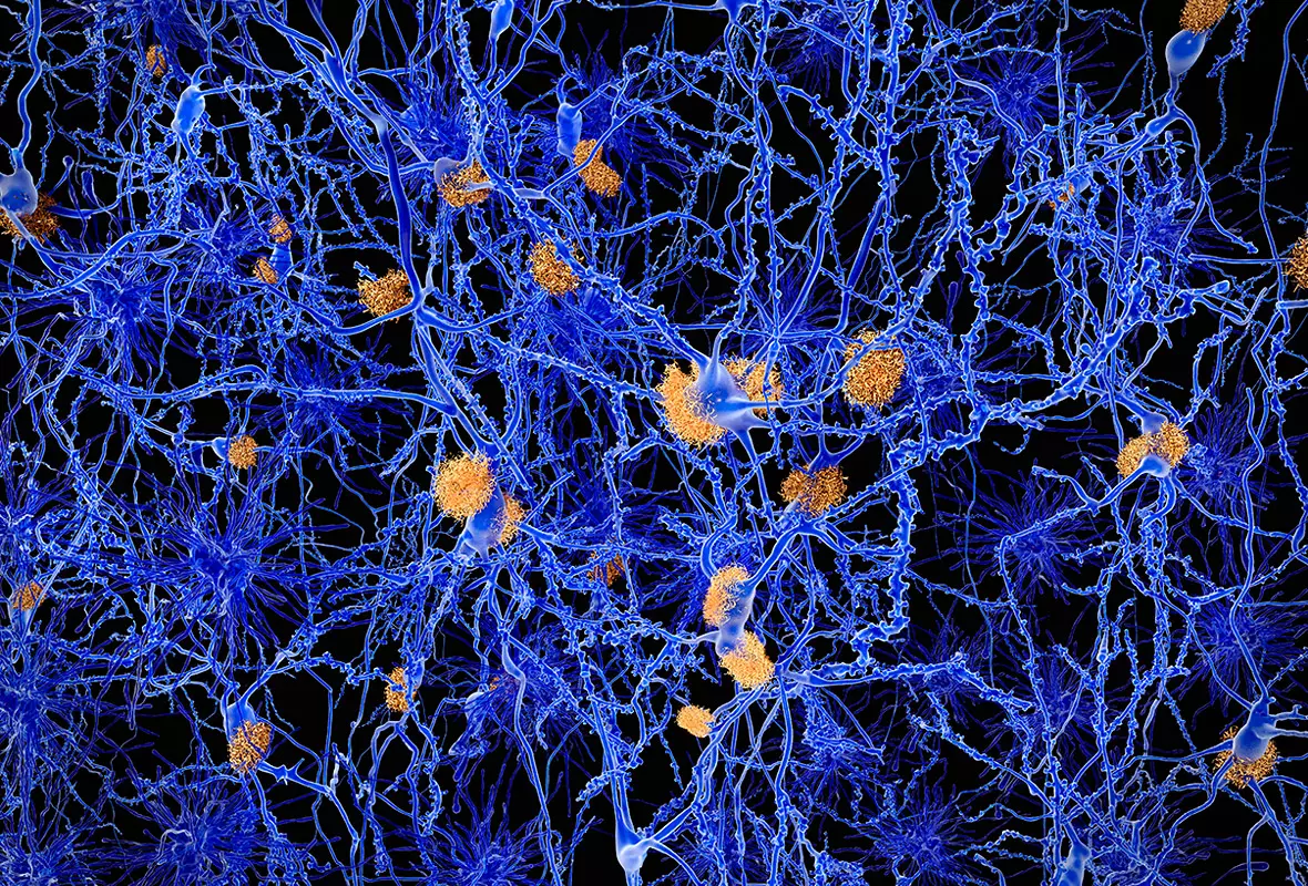 A gépi tanulás előre jelzi az Alzheimer -kórt 66361_1