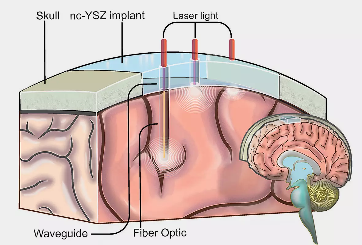 Az új technológia lehetővé teszi, hogy az implantátumok adatokat küldjenek okostelefonra 68495_1